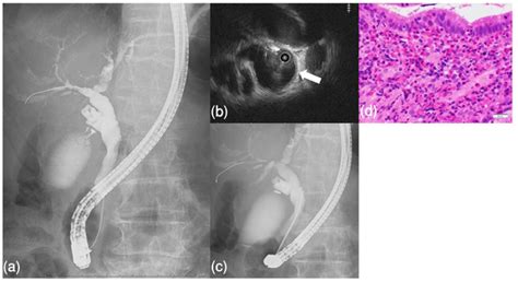 A Endoscopic Retrograde Cholangiopancreatography Revealed No Sites Of Download Scientific