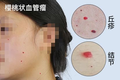 红痣与朱砂痣的区别图片彩牛养生