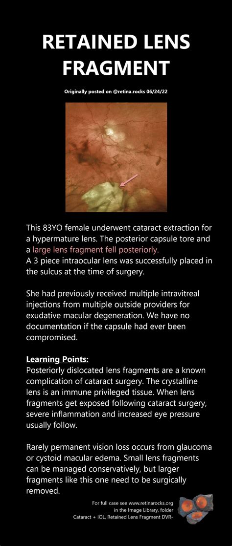Miscellaneous Cataract Dislocated Iol Retained Lens Fragments Retina Rocks