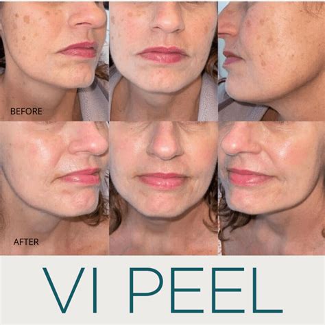Pigmentation And Sun Damage Causes Prevention And Treatments
