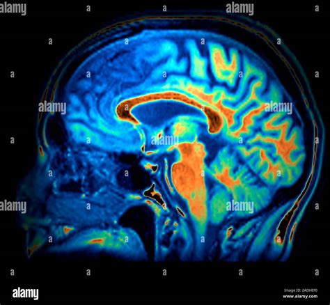 Frontal Temporal Dementia Coloured Magnetic Resonance Imaging Mri