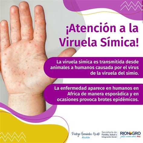 Confirmación de primeros casos de Viruela Símica en Colombia En Rionegro se hace un llamado a