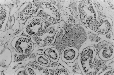 Hande 100x Leydig Cells In Nodular Configuration In Intertubular Areas