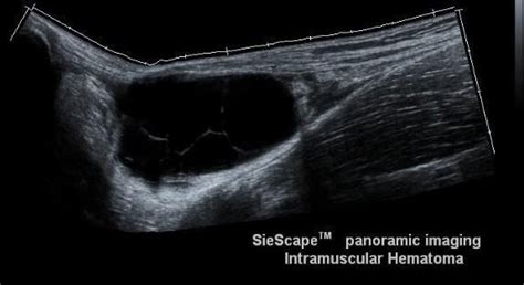 Chronic Hematoma Ultrasound Seroma Hsiwa