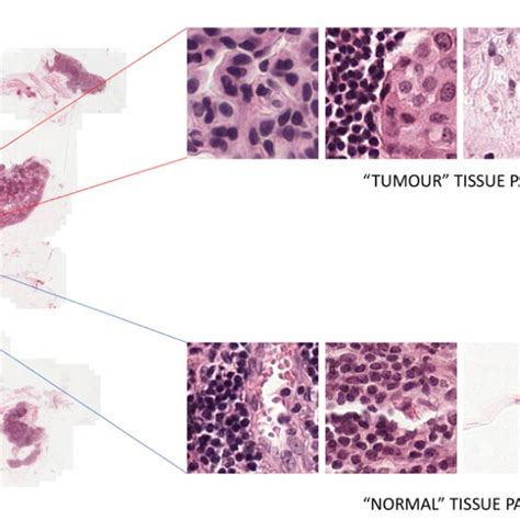 Breast Cancer Metastases Patch Extraction Pipeline On Lhs Wsi With