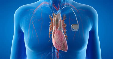 A Navigation System To Guide Placement Of Cardiac Pacemaker Leads Health~holland