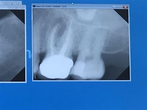 Emergency Pulpectomy Today Found Out I Need 2 Root Canals Instead Of