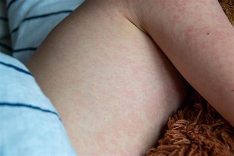 Maladie Virale Rougeole éruption Cutanée Sur Le Corps De L enfant