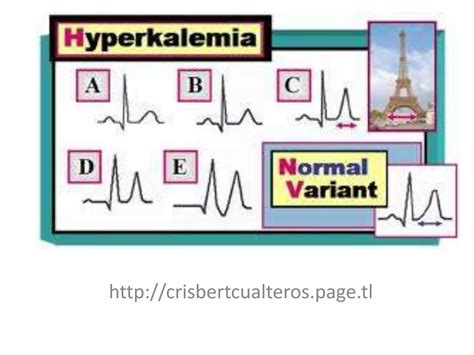 Hyperkalemia Pptx
