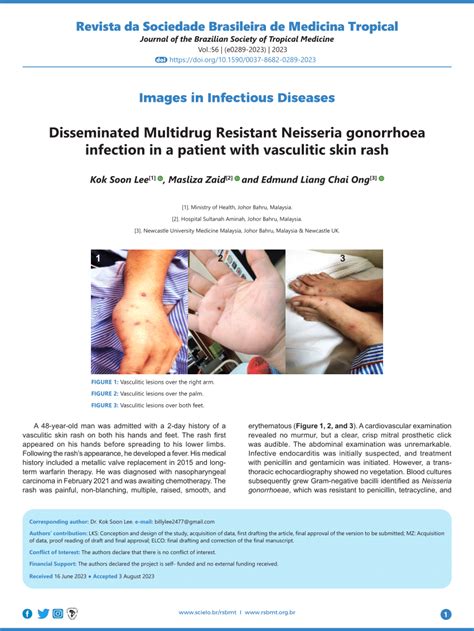 Pdf Disseminated Multidrug Resistant Neisseria Gonorrhoea Infection