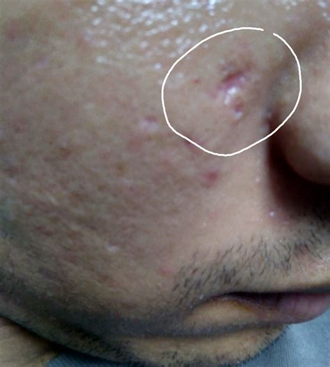 Chicken Pox Scars After Excisionwhat Next Acne Scars Forum