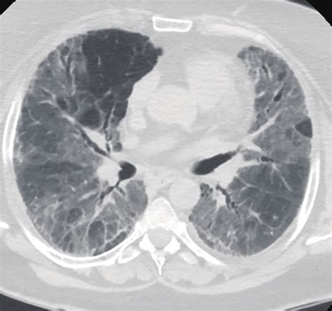 Preoperative High Resolution Computed Tomography Scan Of The Chest Download Scientific Diagram