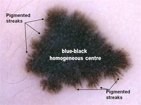 Virtual Dermatoscope