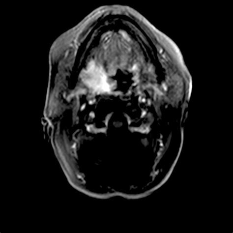 Contrast Enhanced Magnetic Resonance Imaging Mri Before Cryoablation