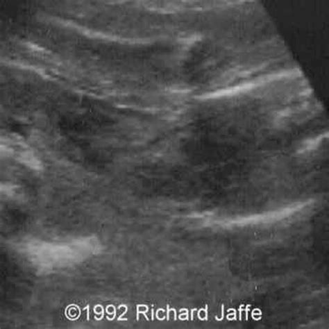 📃 Conjoined Twins Structural Anomalies