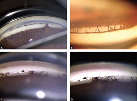 Posterior Embryotoxon Gonioscopy