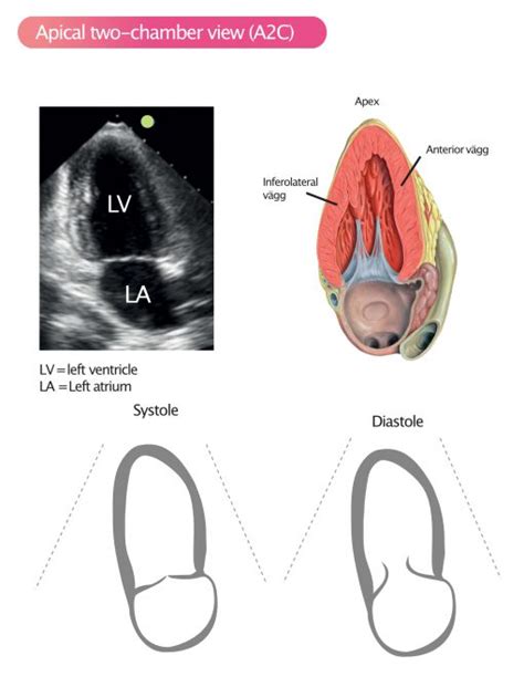 Apical Two Chamber View A2c Echocardiography Ultrasound Image The