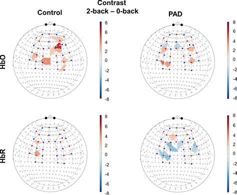 Microvascular Dysfunction And Neurovascular Uncoupling Are Exacerbated In Peripheral Artery