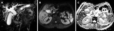 Figure 1 From Role Of Diffusion Weighted Magnetic Resonance Imaging In