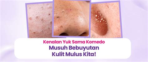 Blackhead Vs Whitehead Kenali Perbedaannya And Cara Mengatasinya