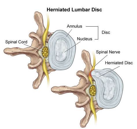 Eccentric Disc Bulge Symptoms Diagnosis And Relief Techniques Vaticmod