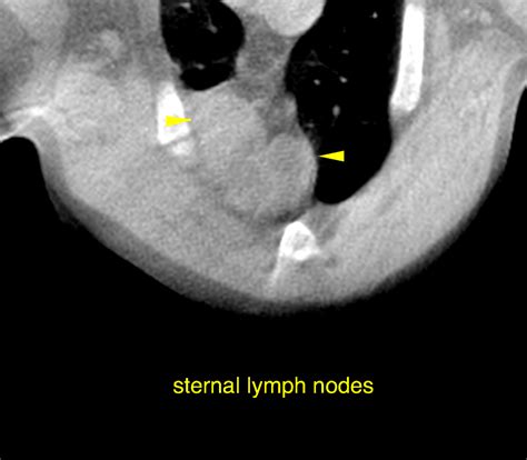 Ct Heart Base Tumor With Pericardial Effusion Likely Mediastinal Lymph Node Malignancy In A