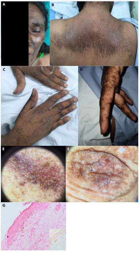 Dermoscopy Of Dermatomyositis In Dark Skin Pmc