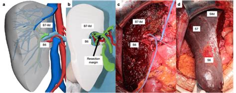 A Case Of Left Trisectionectomy Preserving The Dorsal Biliary Duct For