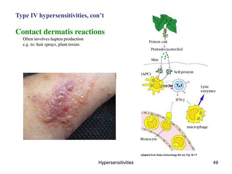Ppt Hypersensitivity And Autoimmunity Powerpoint Presentation Free Download Id 313150