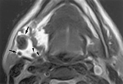 Hemangioma From Head To Toe Mr Imaging With Pathologic Correlation