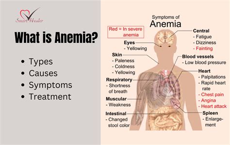 What Is Anemia Types Causes Symptoms And Treatment Smarthealerpk