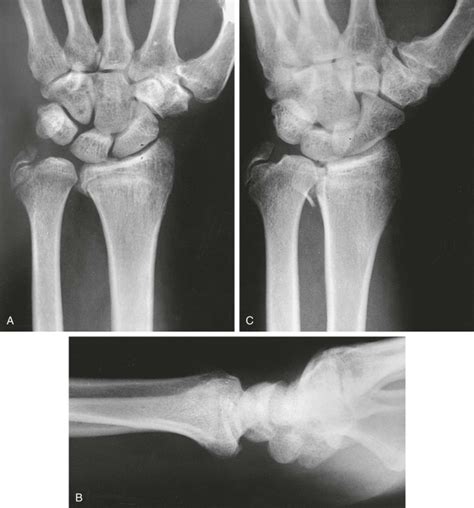 Fractures Of The Distal Radius Musculoskeletal Key
