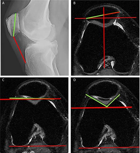 Lateral View Radiographs Showing A Insall‐salvati Ratio Patellar