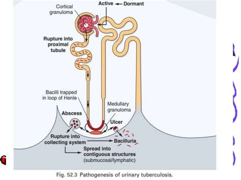 Urinary Tract Tuberculosis Pptx