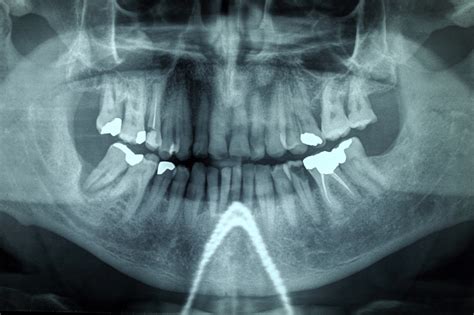Cosè Lortopantomografia Dentistatv