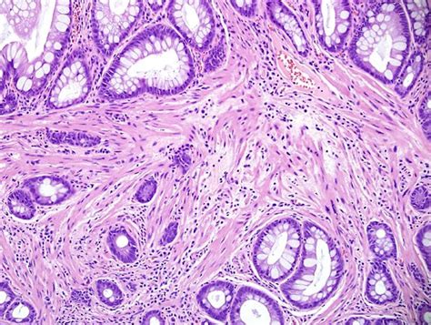 Rectal Prolapse Polyp Histology