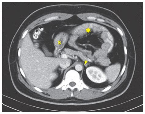 Barium Meal Followthrough And Ct Findings In Paraduodenal Hernia Annals Of Saudi Medicine