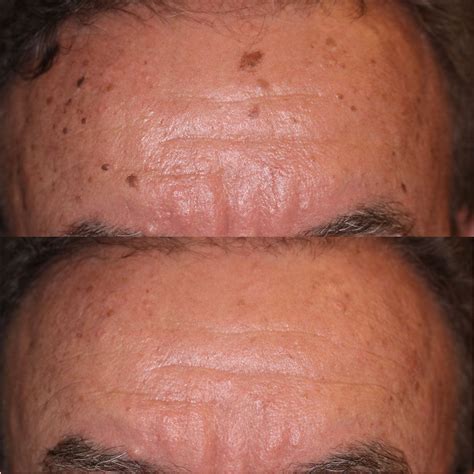 Laser Mehr Info Fiebiger Eiler