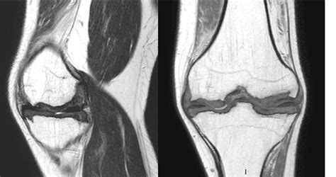Figure 1 From Extensive Arthroscopic Chondroplasty For Cartilage
