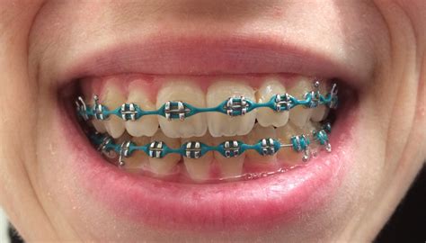 My Braces Journey Before Pakai Braces 😀