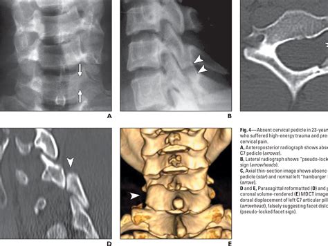 Figure 1 From Mdct Of Variations And Anomalies Of The Neural Arch And