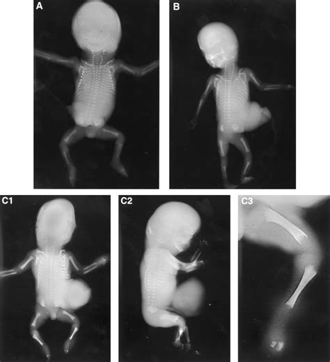 A New Lethal Syndrome Of Exomphalos Short Limbs And Macrogonadism