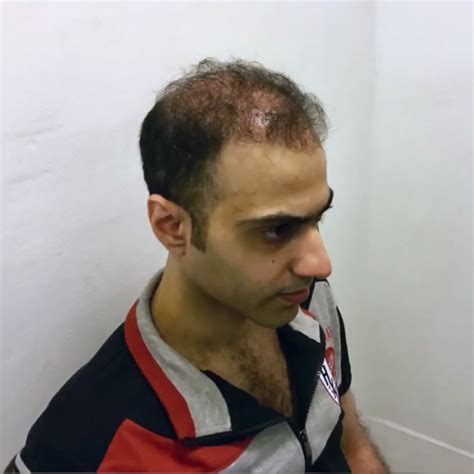 Patient Shares Story Of Bad Hair Transplant In Turkey Fight The Fight
