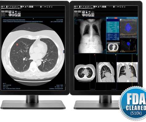 Fda Clears Ai Powered Software For Lung Nodule Detection On Chest Ct