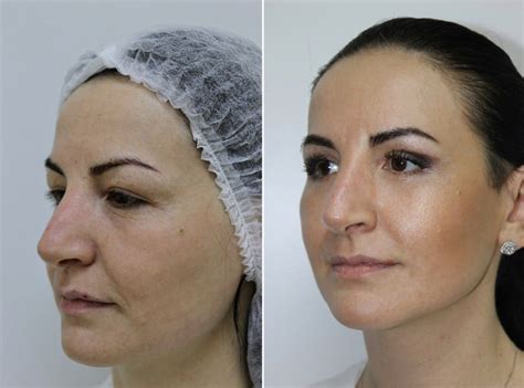 Нити Коги Фото До И После – Telegraph