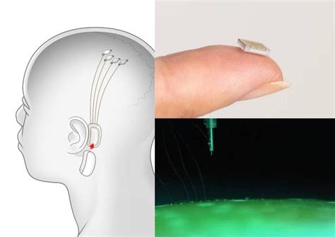 Musks Neuralink Unveils Threads That Link Brains To Computers