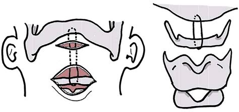 Schematic Showing Of Hyoid Suspension Procedure Two Incisions Were