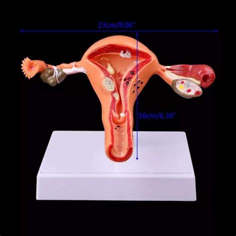 Promo Ready Pathological Uterus Ovary Anatomical Model Anatomy Cross