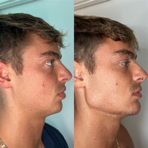 Chiseled Jaw Before And After