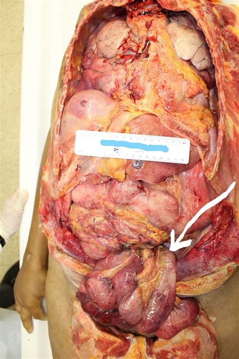 Ischemic Bowel Disease 3rd Eye Forensics Lab Alabama